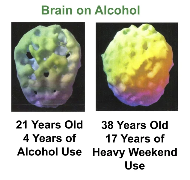 Before And After Alcohol Brain