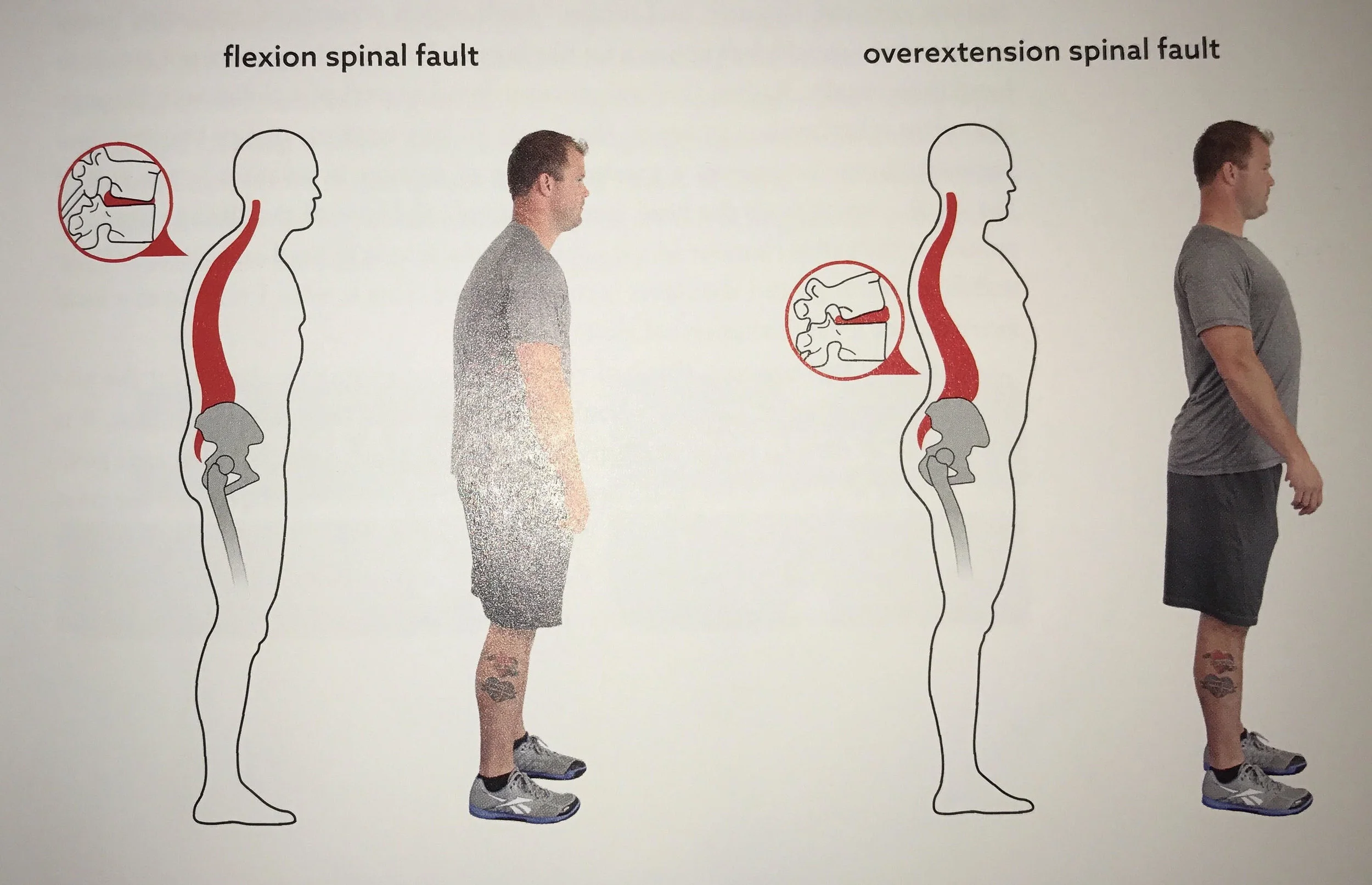 How I've Prevented More Lower Back Pain in the Last 12 Years (After 2 ...