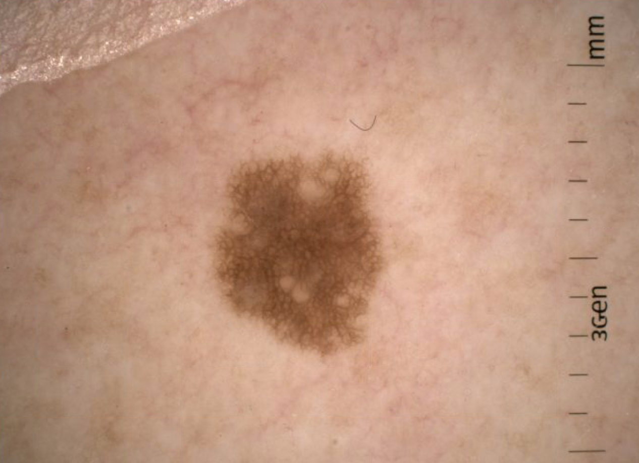 Mole Check Technology for Skin Cancer Screening: An Interview with ...