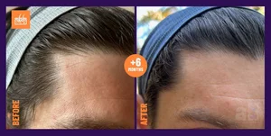 OneSkin Hair Serum Review: My 6-Month OS-01 Before/After Results — A ...