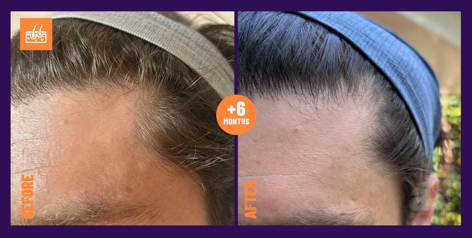 OneSkin Hair Serum Review: My 6-Month OS-01 Before/After Results — A ...