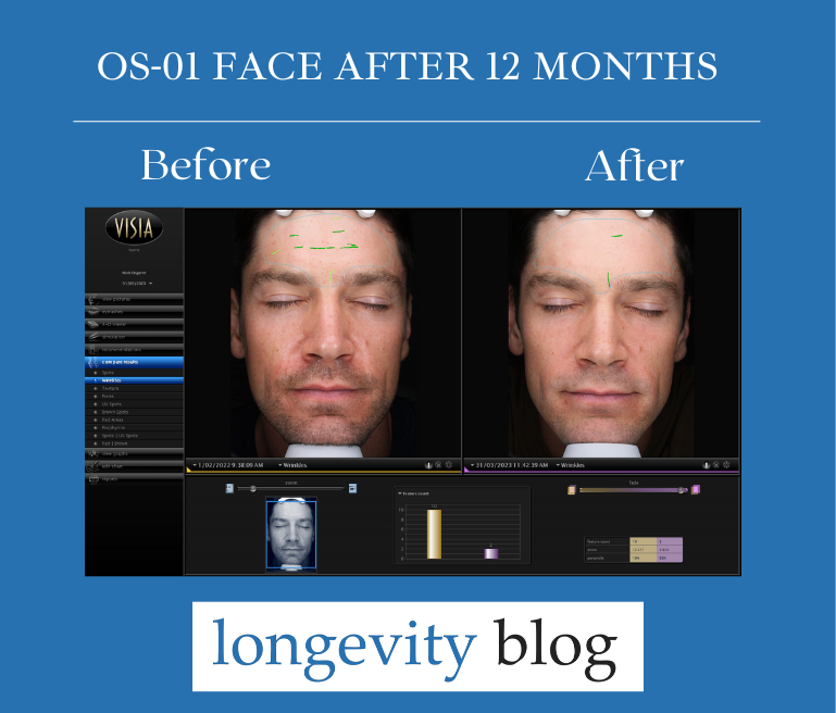 OneSkin Review - Before and After with Images — nickengerer.org