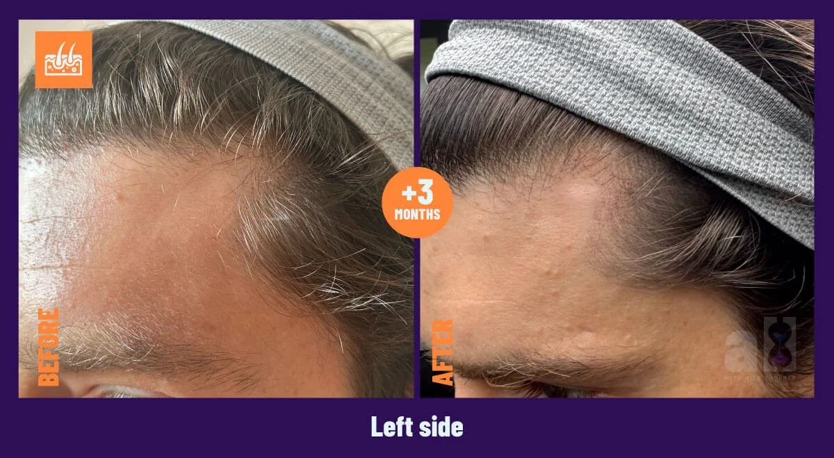 OneSkin Hair Serum Review: My 6-Month OS-01 Before/After Results — A ...
