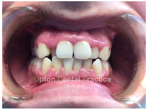 Invisalign — Upton Dental Practice