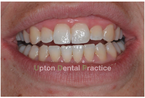 Invisalign — Upton Dental Practice
