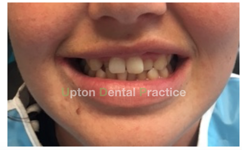 Invisalign — Upton Dental Practice