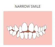 Invisalign® Clear Braces — What You Can Expect