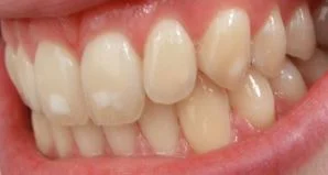 What is Fluorosis? | Dental Fluorosis Causes | CC Dental Perth