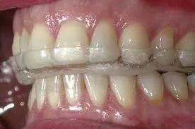 What is Bruxism? - Symptoms, Causes and Treatment | Blog | CC Dental