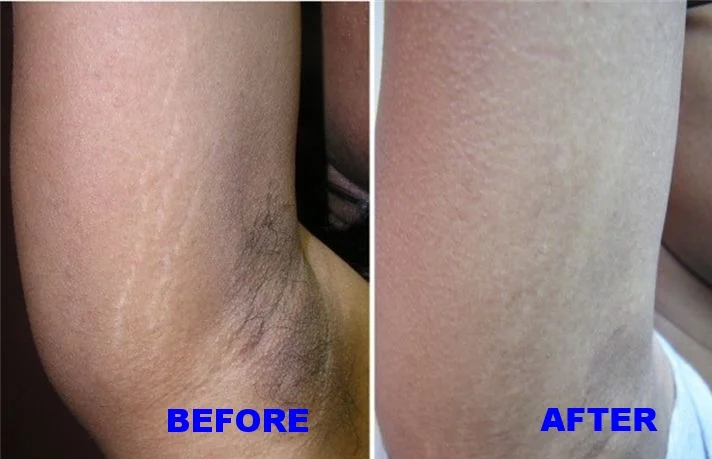 Microneedling with PRP Toronto | Best Microneedling Treatment