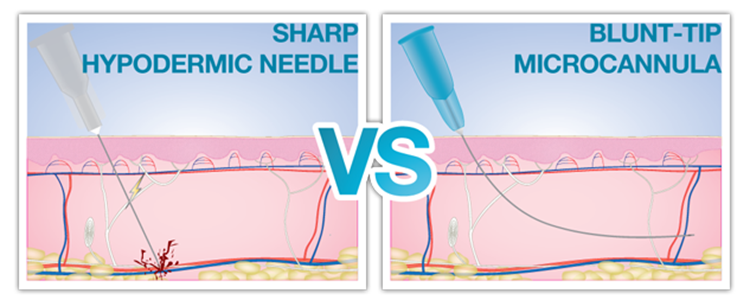 What’s more accurate – Cannulas vs Needles