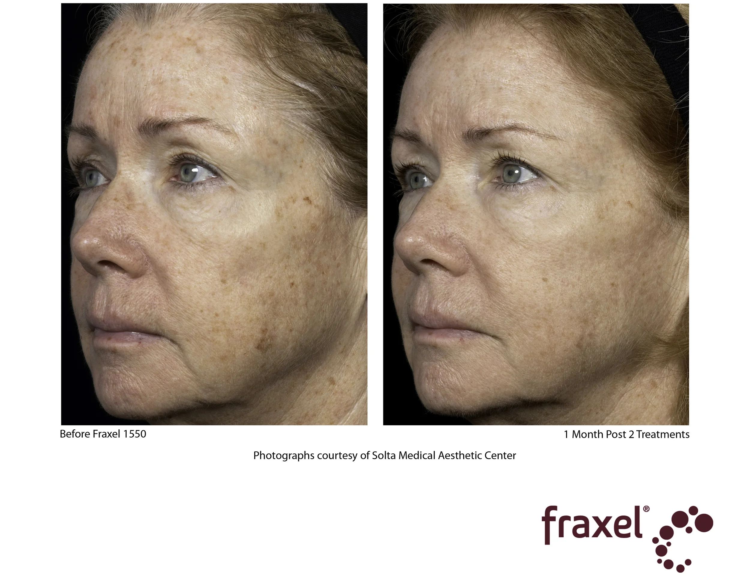 Fraxel Dual — Peninsula Dermatology