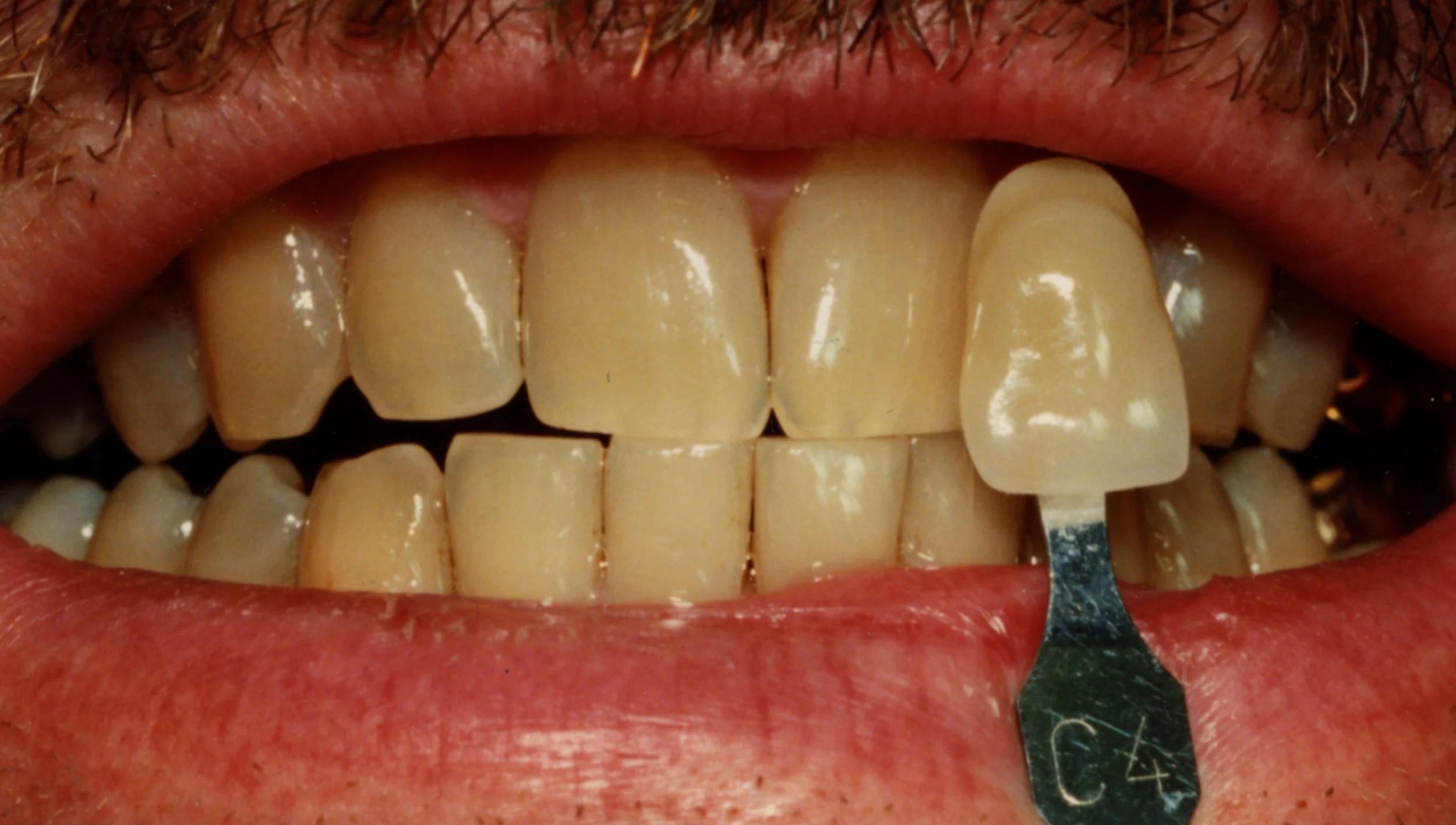 Professional Minneapolis Teeth Whitening - Ivory Dental Group