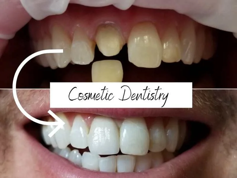 Beautiful Dental Crowns SHOULD Look Like Natural Teeth! - Ivory Dental ...