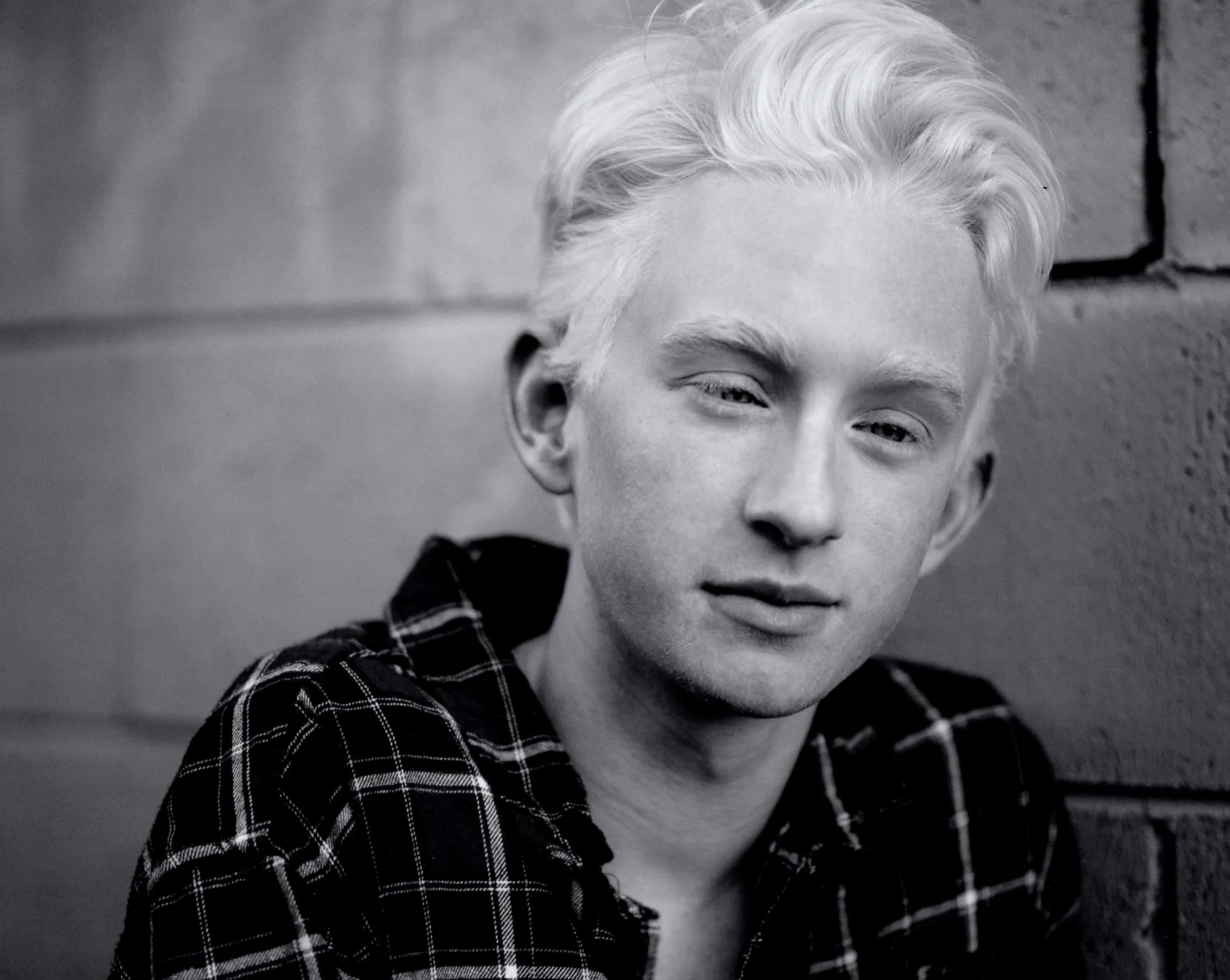 What is Ocular Albinism — The Vision of Children Foundation