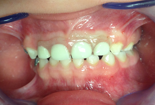 Before and After Pediatric Dental Cases — Bunker Hill Pediatric ...