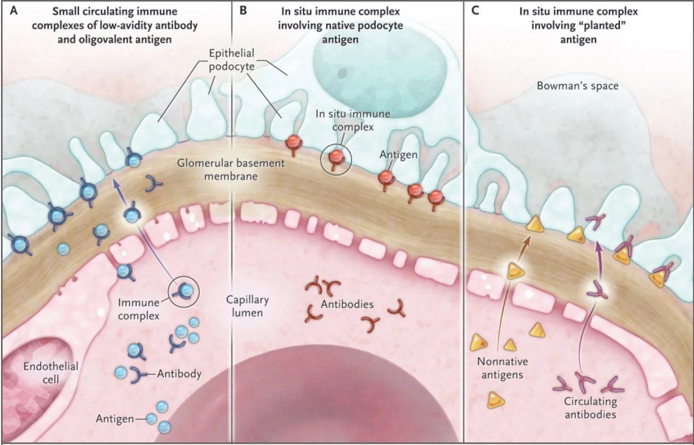 MENTOR: Is Rituximab Ripened enough for Membranous? — NephJC