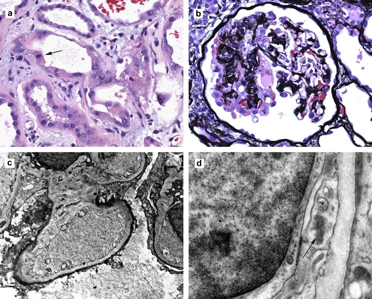 COVID in the Kidney: An Autopsy Series — NephJC