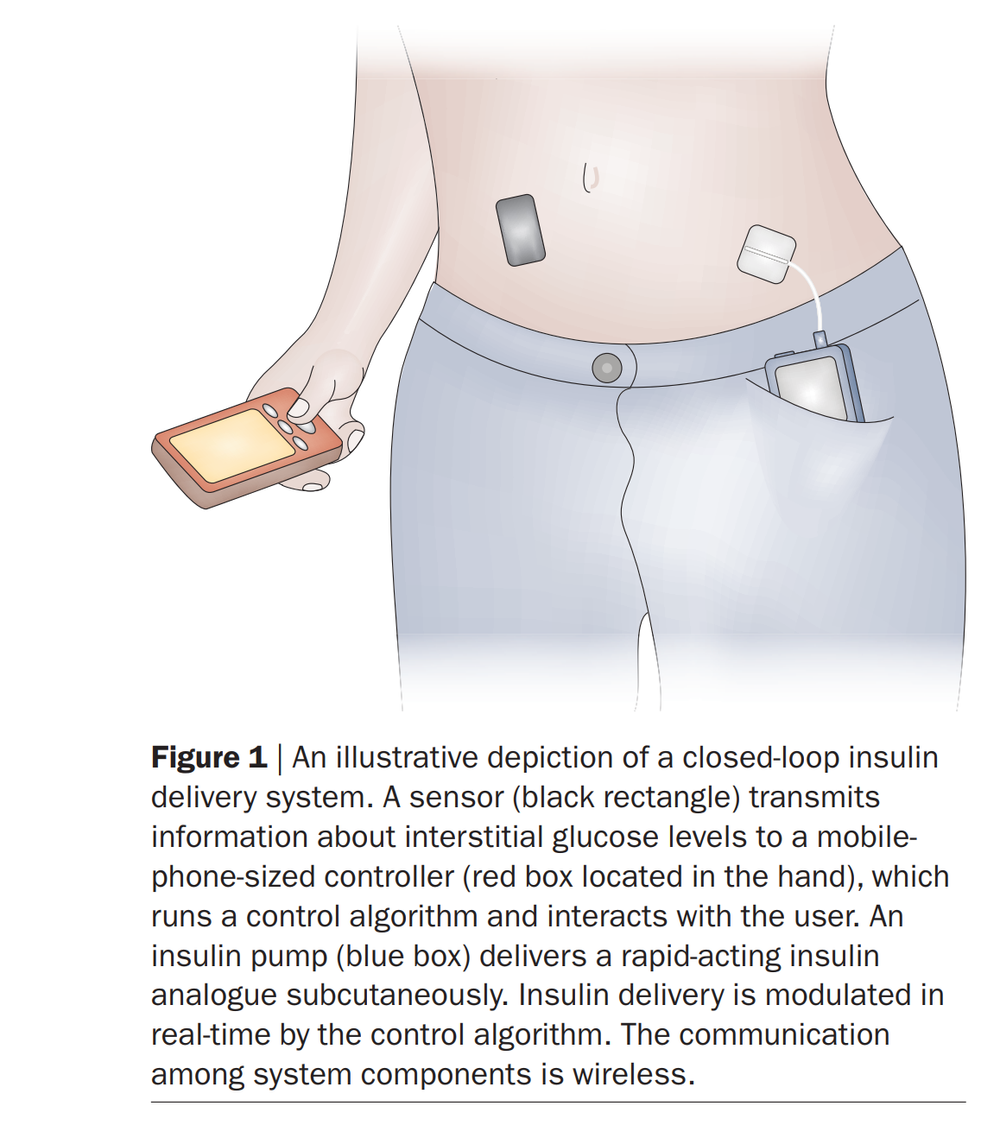Diabetes in Dialysis: Closing the Loop — NephJC