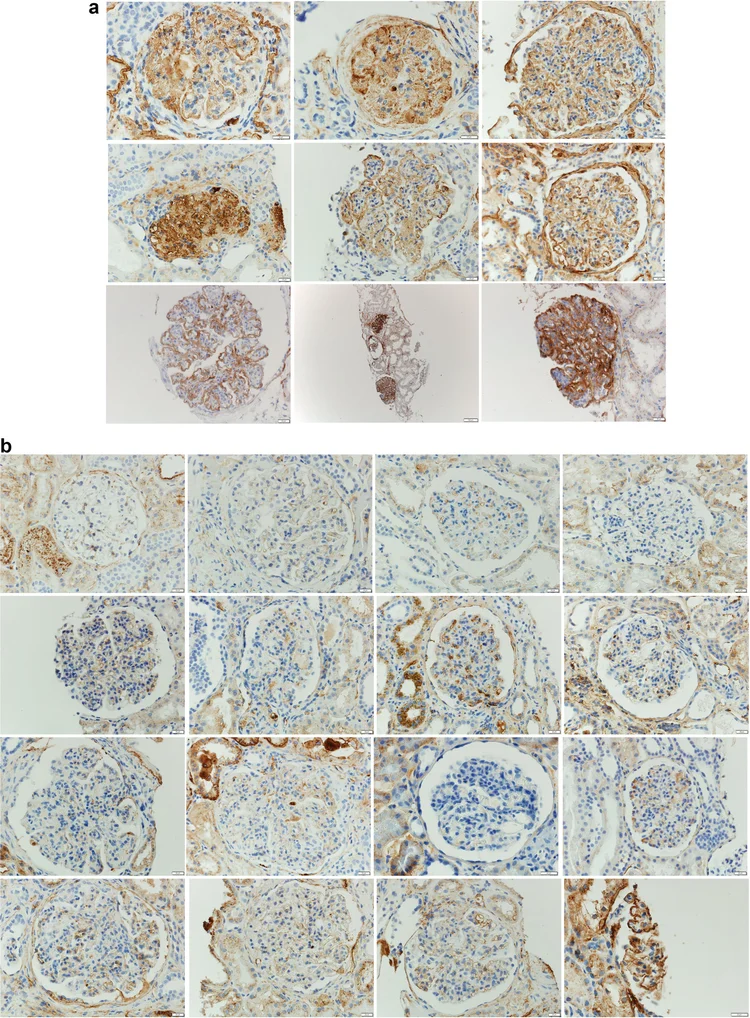 Shedding Light on the Dense Matter of C3 Glomerulopathy — NephJC