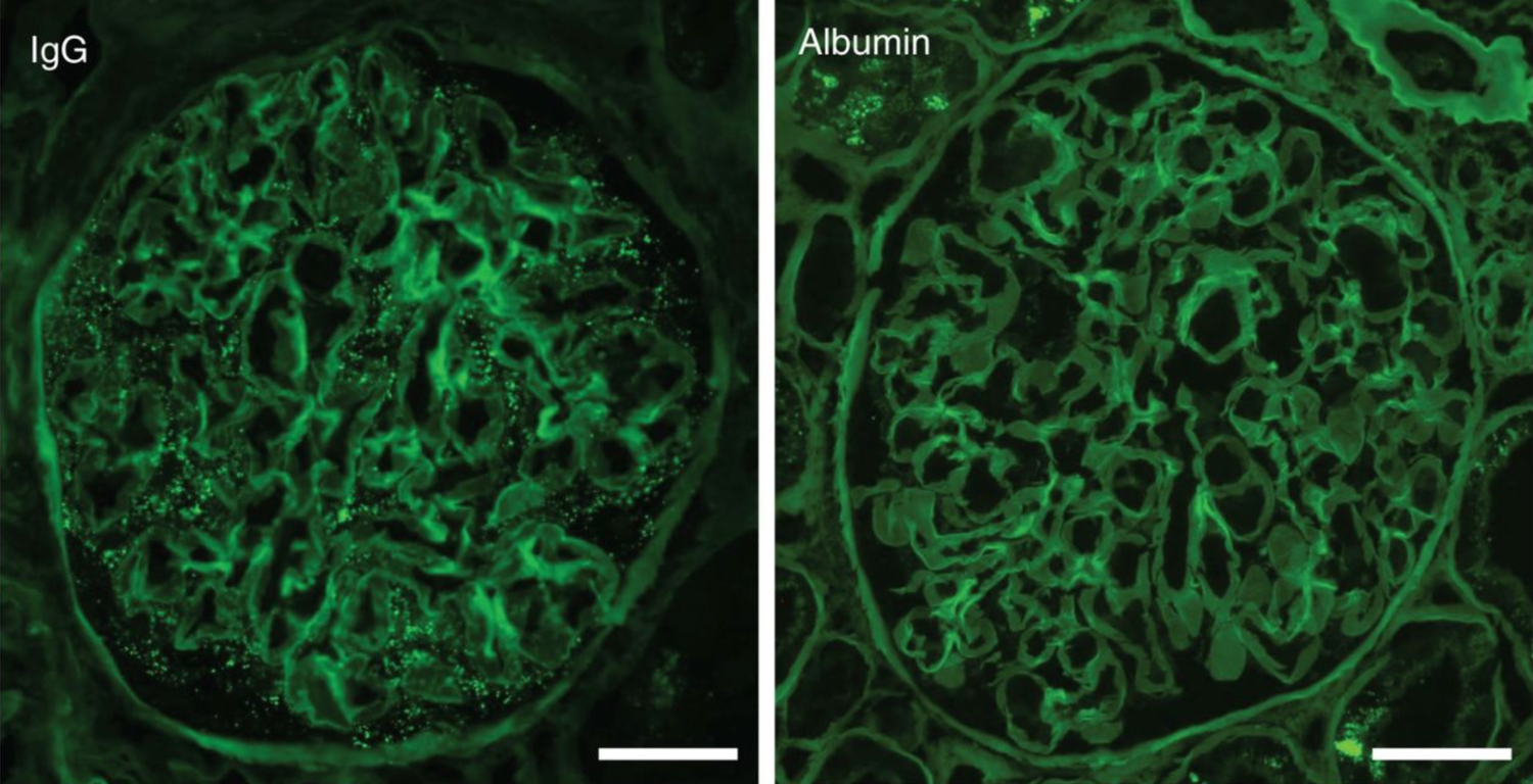 Nephrin in Nephrotic Syndrome — NephJC