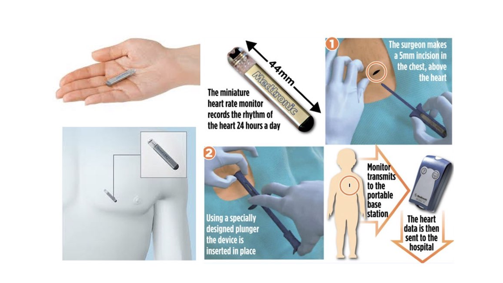 Potassium Rollercoaster Heartbreak — NephJC