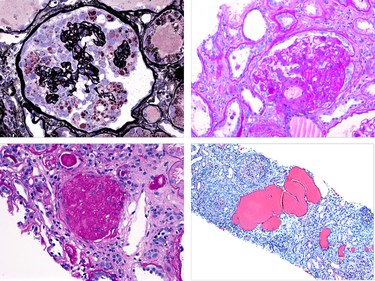 Inaxaplin and proteinuric kidney disease treatment:Taking the octopus ...