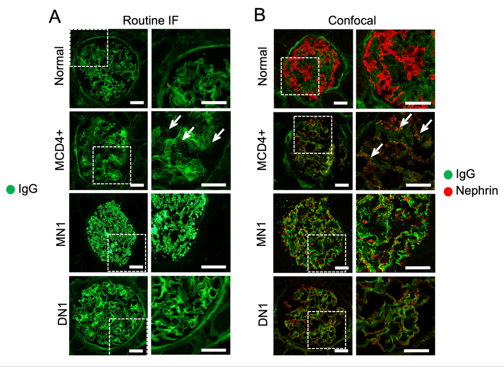 Nephrin in Nephrotic Syndrome — NephJC