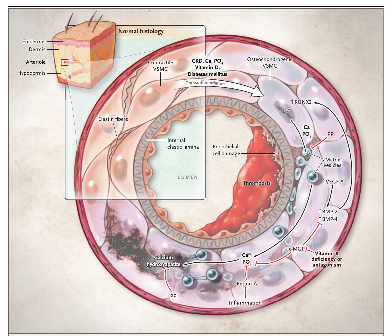 STS in Calciphylaxis — NephJC