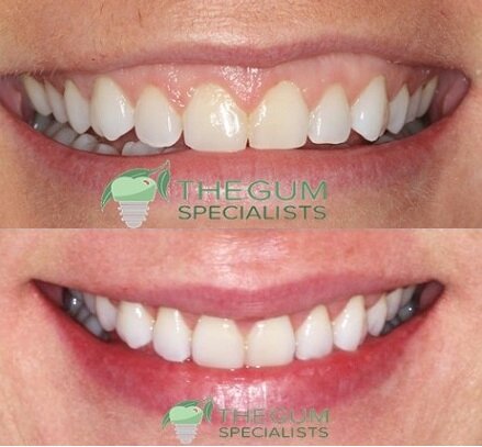 Crown Lengthening — The Gum Specialists