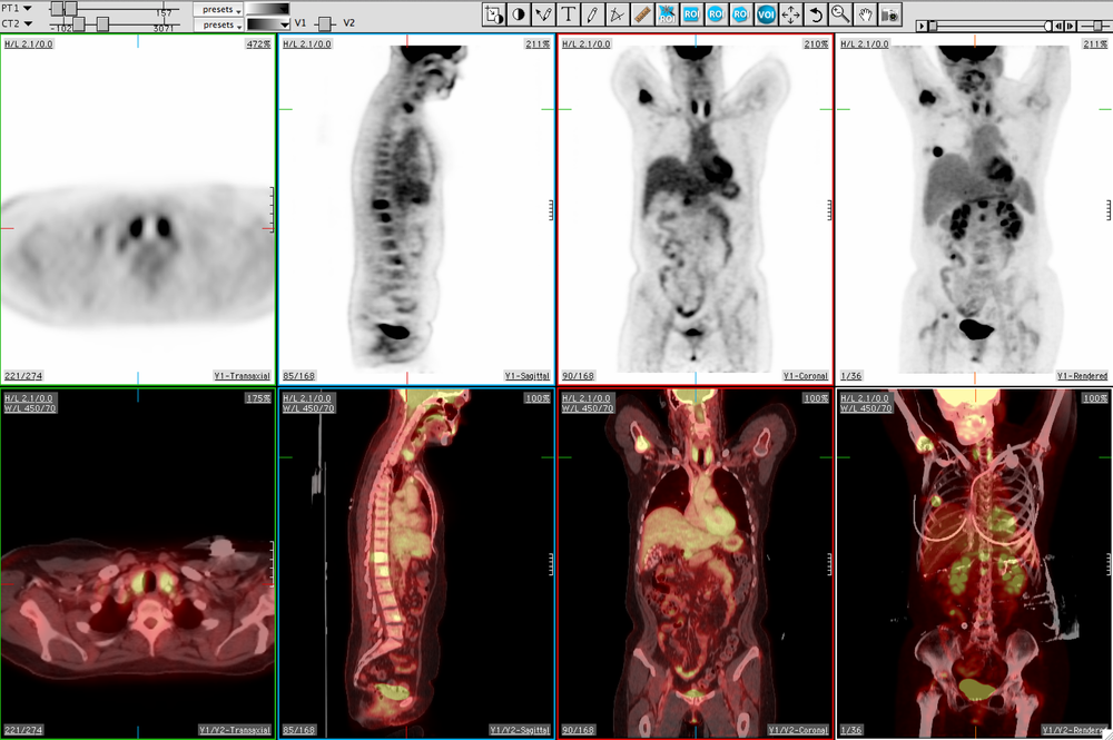 Nuclear Medicine and PET/CT images from the MedView by MedImage — MedImage