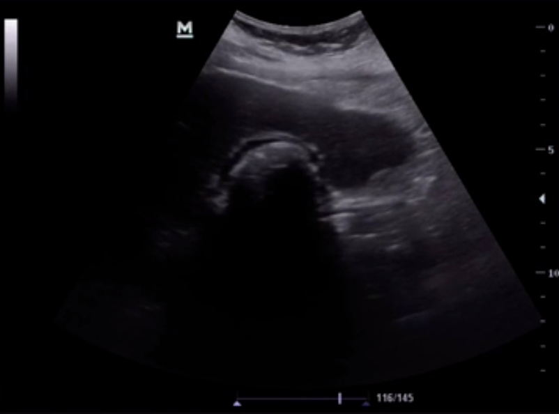 Ultrasound Leadership Academy: RUQ Ultrasound — EM Curious
