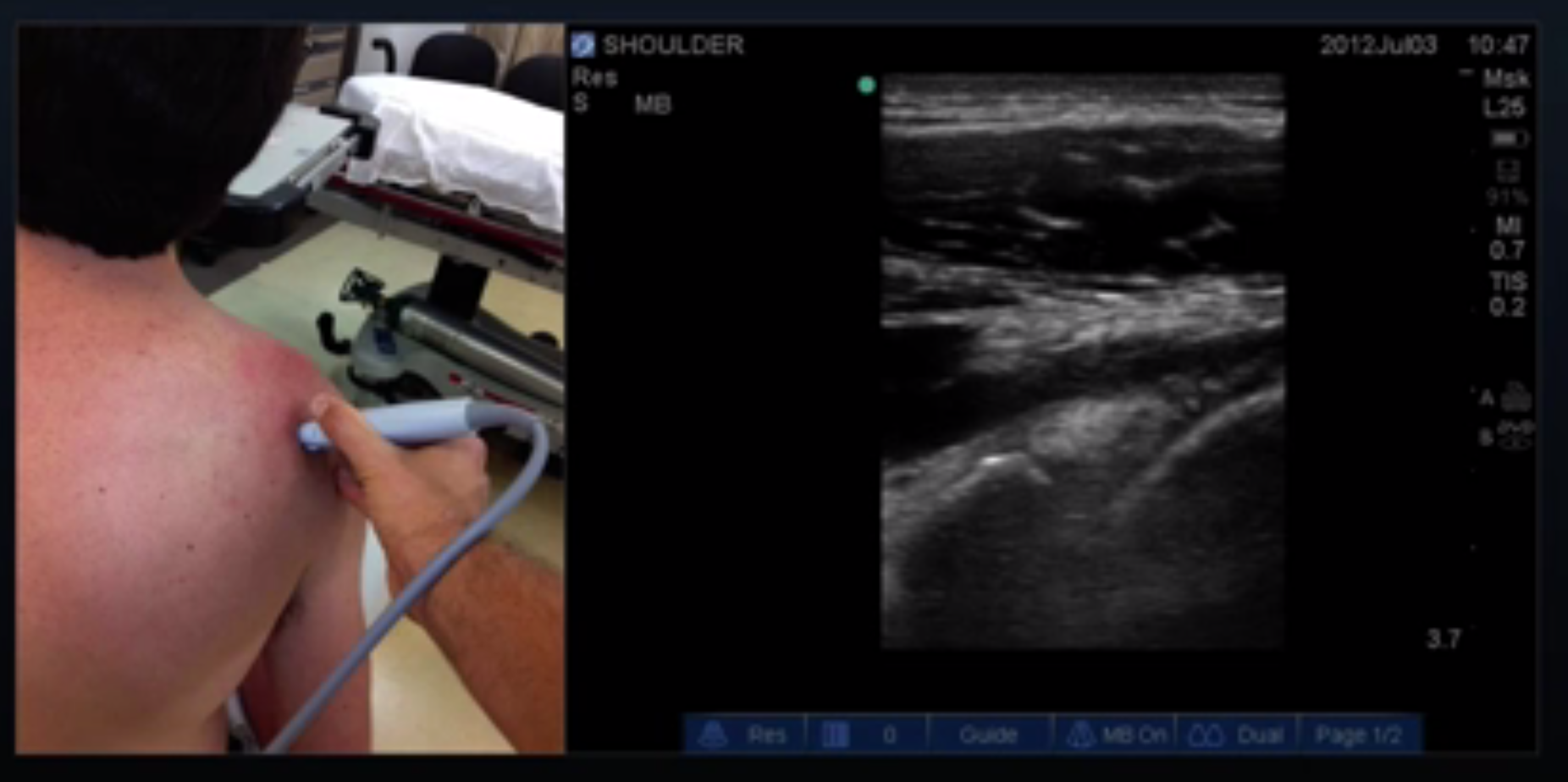 Ultrasound Leadership Academy: Intro to Shoulder Evaluation — EM Curious