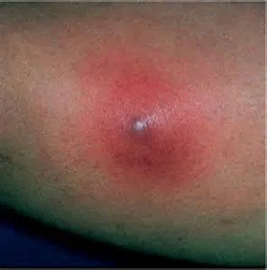 Bug Bite Vs Staph Infection