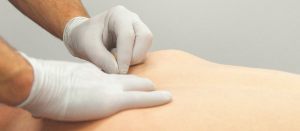 Dry Needling For Injury Recovery - Spectrum Health
