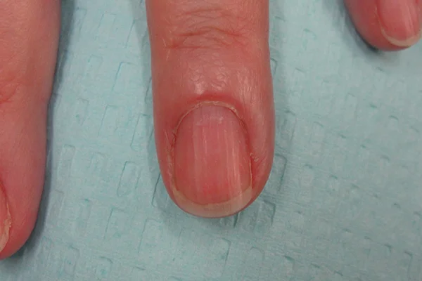 Onycholysis — Dr. Dana Stern | Dermatologist | Nail Specialist