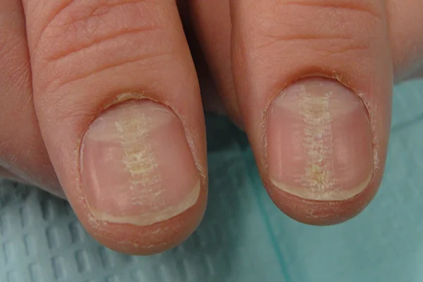 Habit Tic Deformity — Dr. Dana Stern | Dermatologist | Nail Specialist