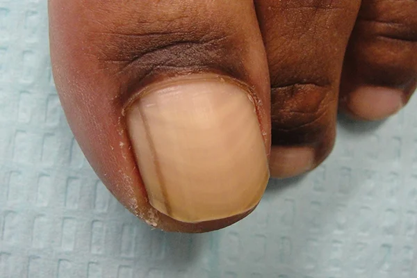 Longitudinal Melanonychia — Dr. Dana Stern | Dermatologist | Nail ...