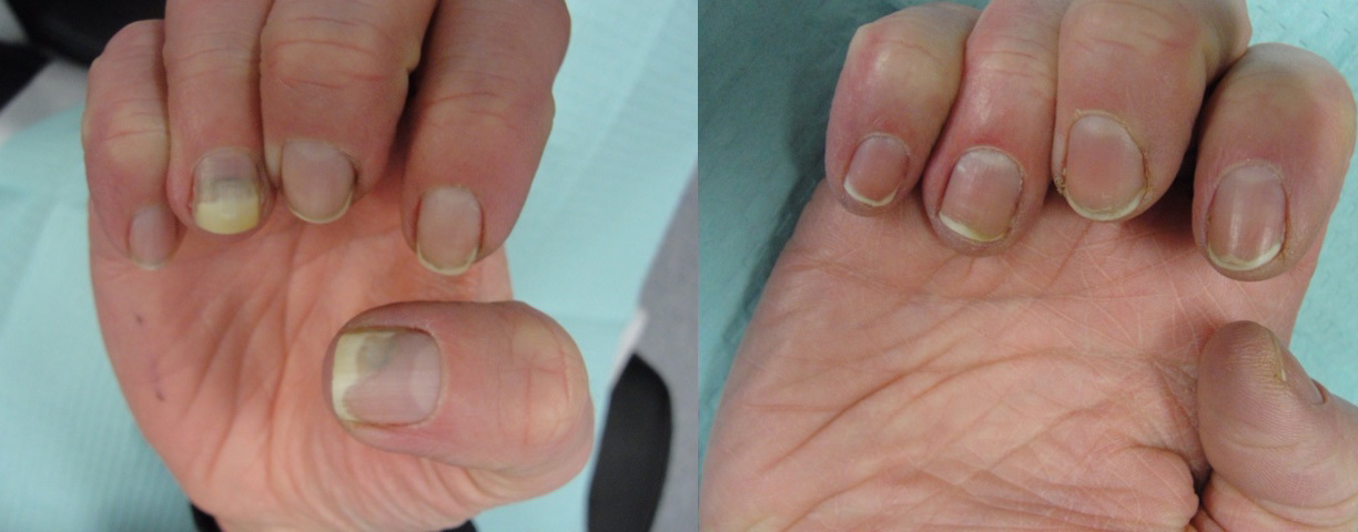 Nail Case Studies — Dr. Dana Stern | Dermatologist | Nail Specialist