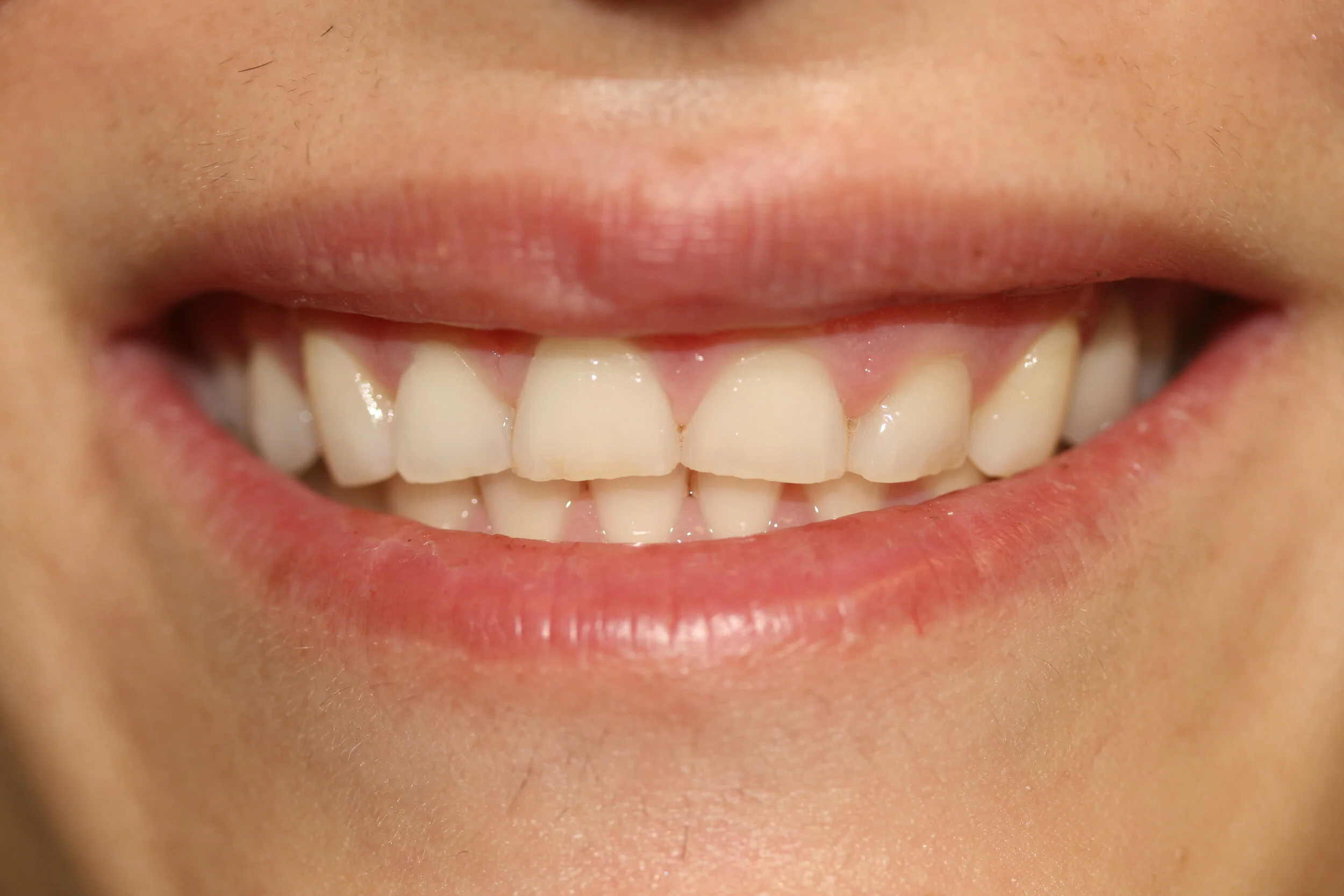 Enhance Your Smile with Composite Bonding | The Hub Dental Rooms ...