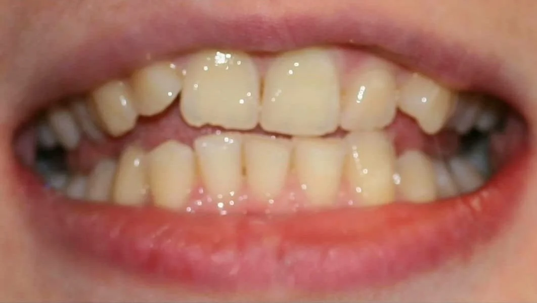 Enhance Your Smile with Composite Bonding | The Hub Dental Rooms — Dental Practice - Notting Hill