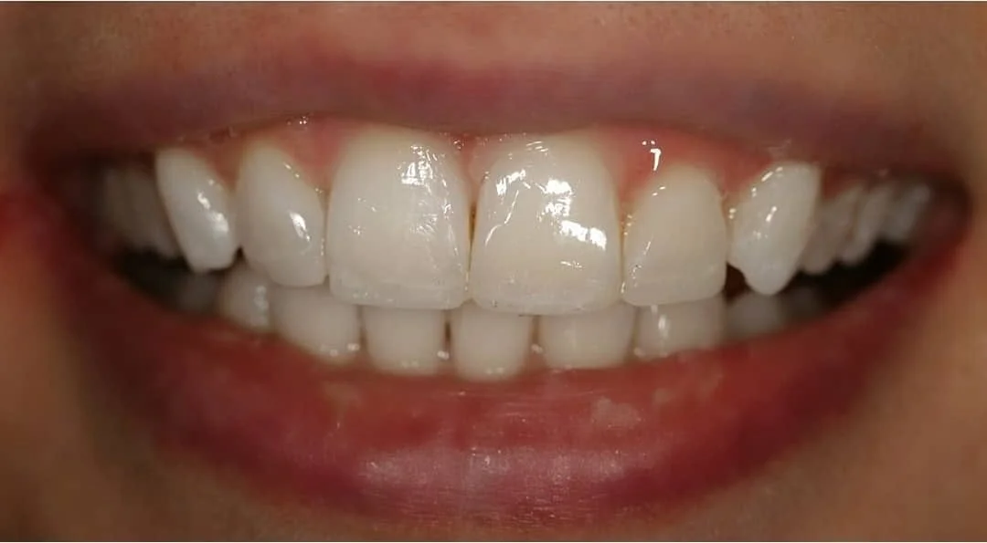 Enhance Your Smile with Composite Bonding | The Hub Dental Rooms — Dental Practice - Notting Hill