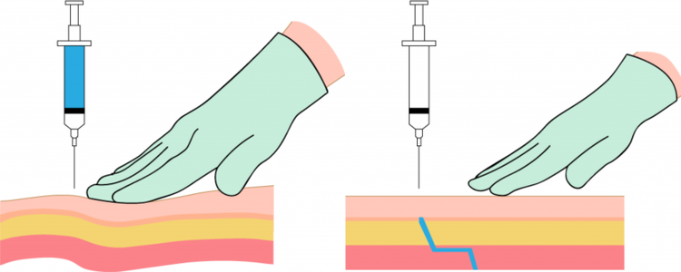 Diagnostics and Therapeutics: Paracentesis in the Emergency Department ...