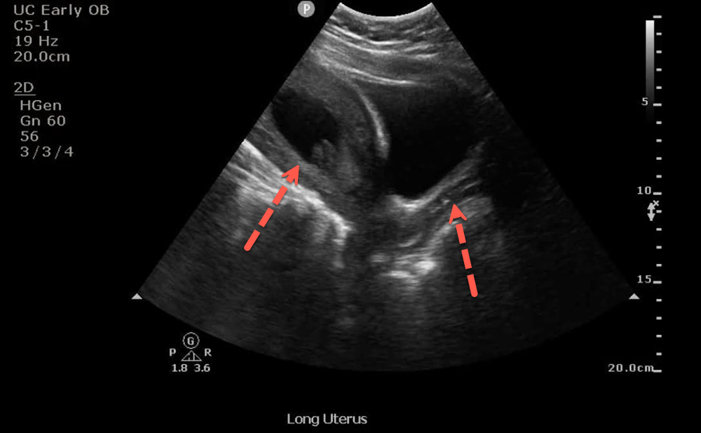 Ultrasound of the Month: No Definitive Yolk Sac, No Definitive IUP ...