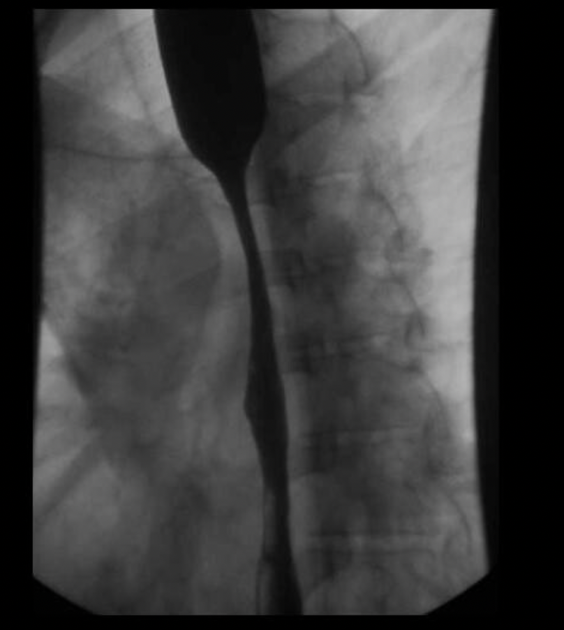 Diagnostics and Therapeutics: Caustic Ingestions in the Emergency ...