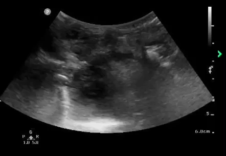 Ultrasound of the Month: Peritonsillar Abscess — Taming the SRU