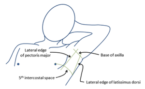 Chest Tube — Taming the SRU
