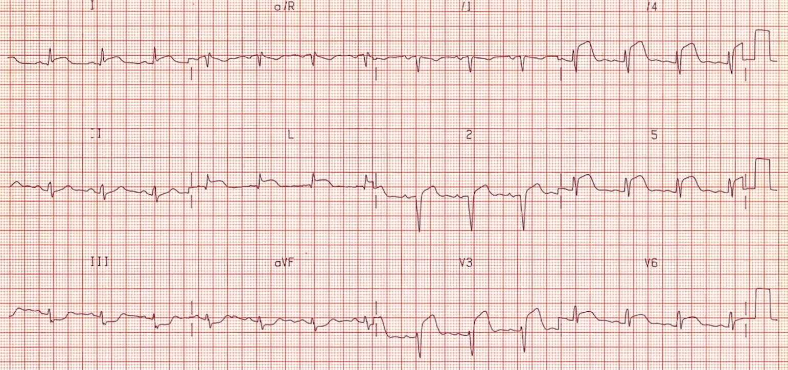 STEMI and STEMI Equivalents, i.e. Who Needs the Cath Lab Now! — Taming ...