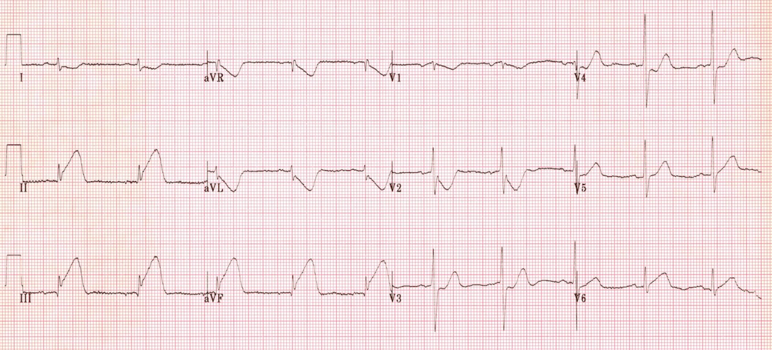 STEMI and STEMI Equivalents, i.e. Who Needs the Cath Lab Now! — Taming ...