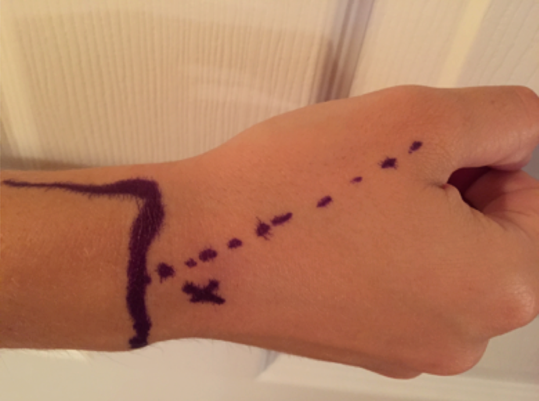 What is Useful in the ED to Help Diagnose or Rule Out Septic Arthritis ...